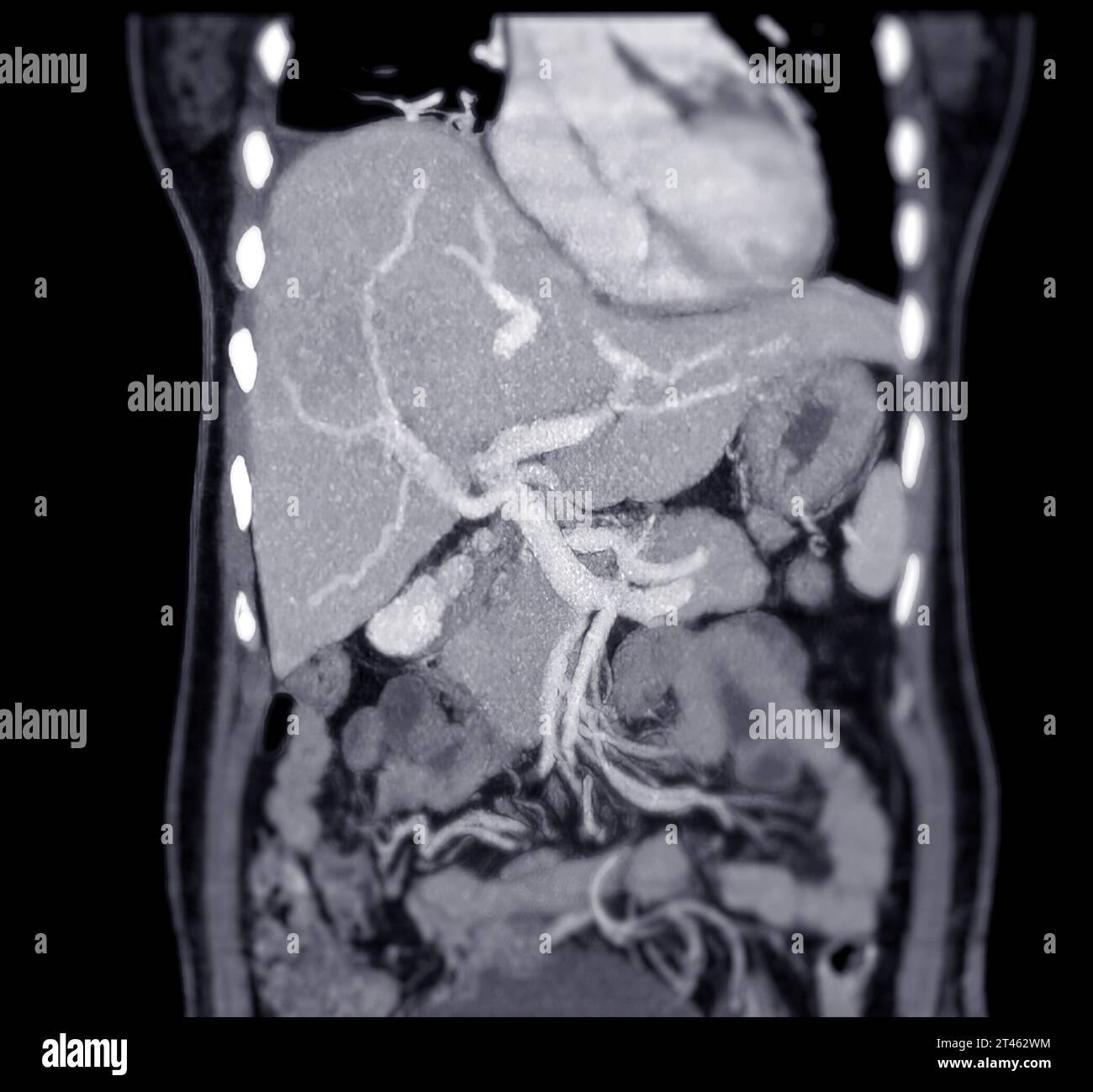 CT upper abdomen coronal view Stock Photo - Alamy