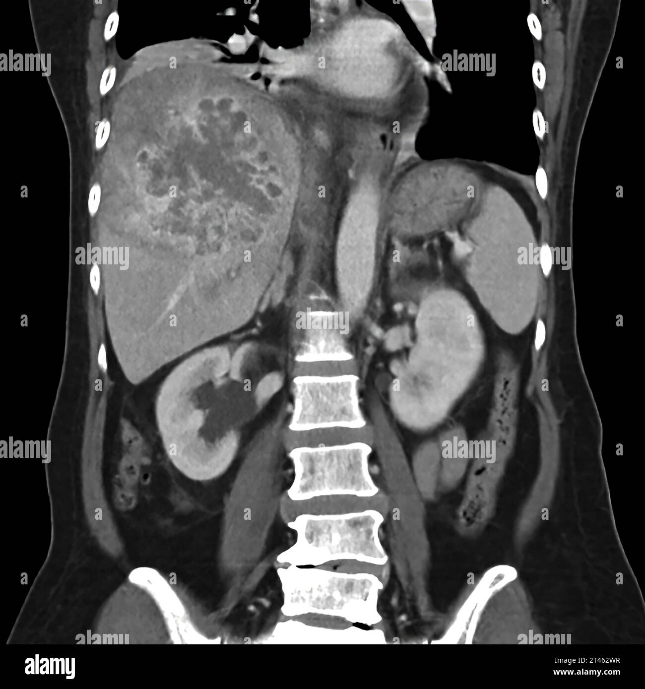 CT upper abdomen coronal view showing DDX is atypical HCC or ...