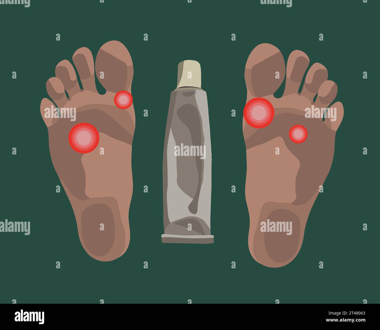 Vector isolated illustration of foot fungus. Fungal ointment Stock ...