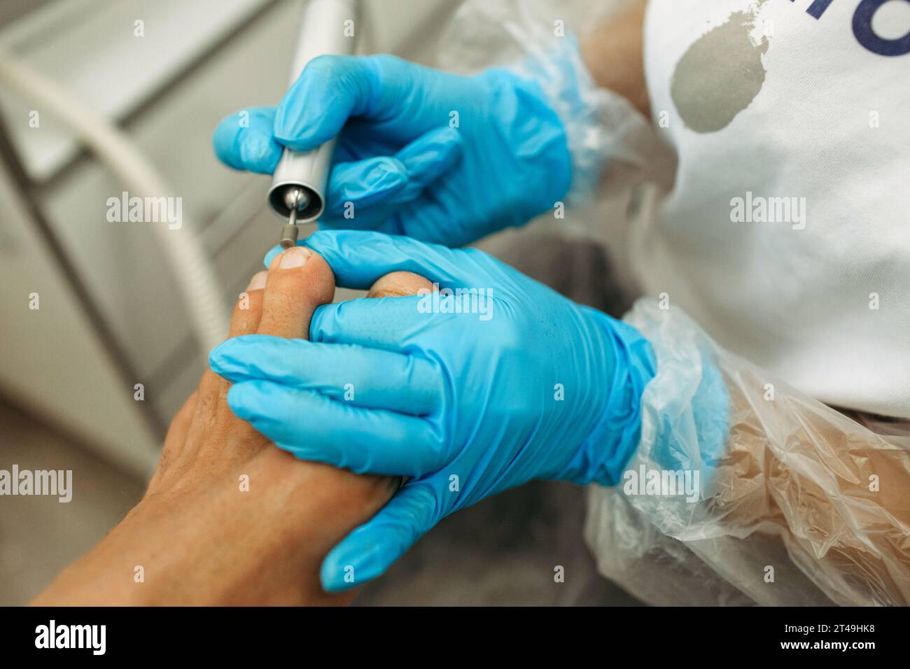 orthopedic doctor in blue gloves treats legs, close-up, treats feet ...
