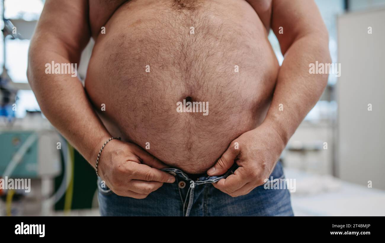 Close up of abdomen of overweight patient. High waist circumference of ...