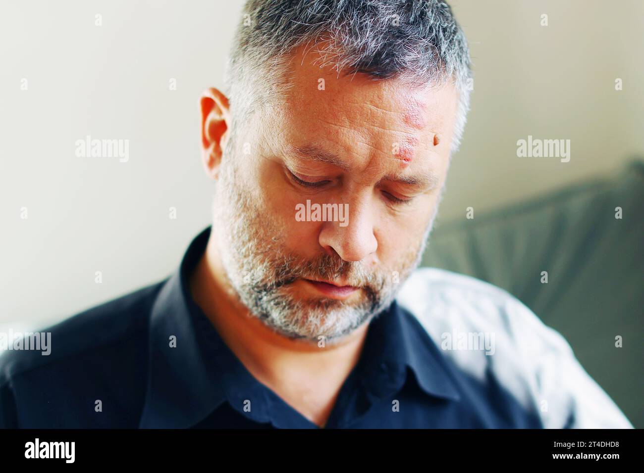 Man with Herpes Zoster (shingles) on the face, close up. man suffering ...