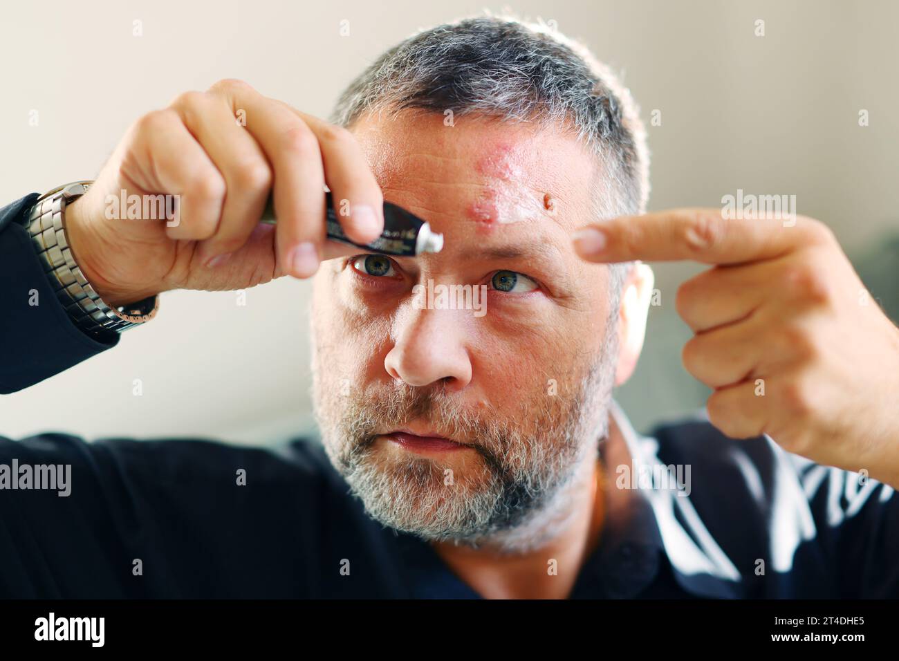 Man with Herpes Zoster (shingles) on the face, close up. man suffering ...