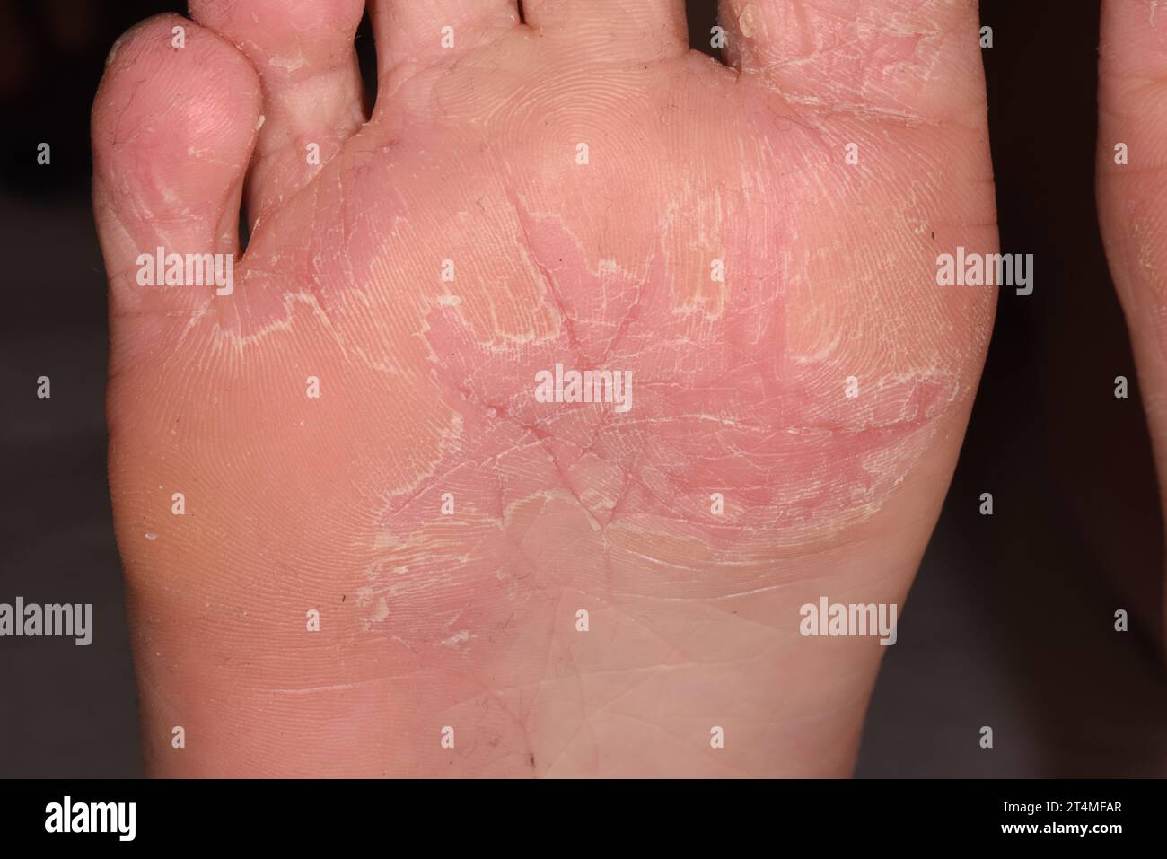 Cracked skin from eczema on the sole of a girl's foot Stock Photo - Alamy