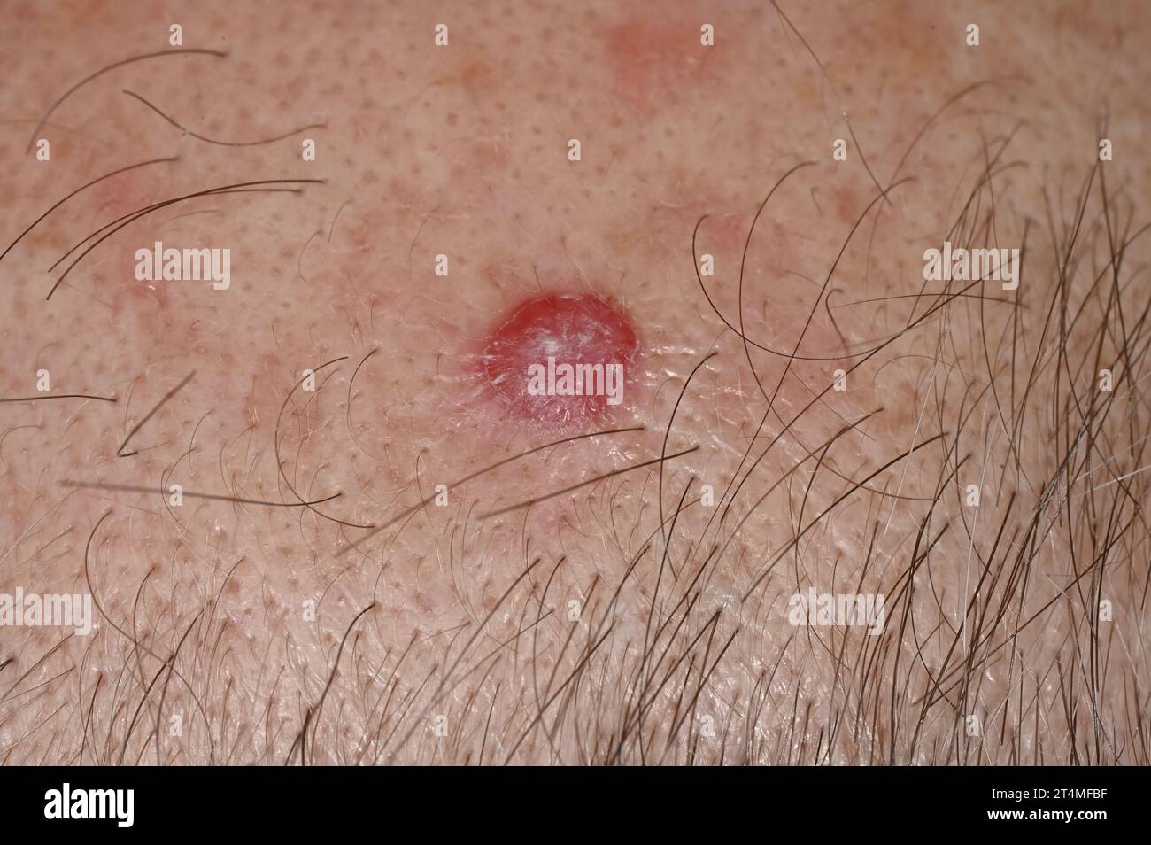 Fibrous histiocytoma on a man's scalp Stock Photo - Alamy