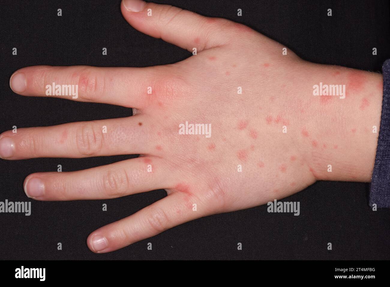 Erythema multiforme on a girl's hand Stock Photo - Alamy