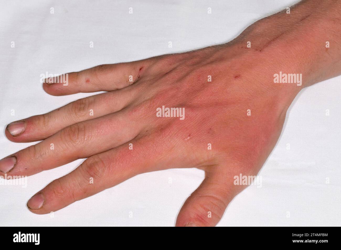 Erythema on a man's hand Stock Photo - Alamy