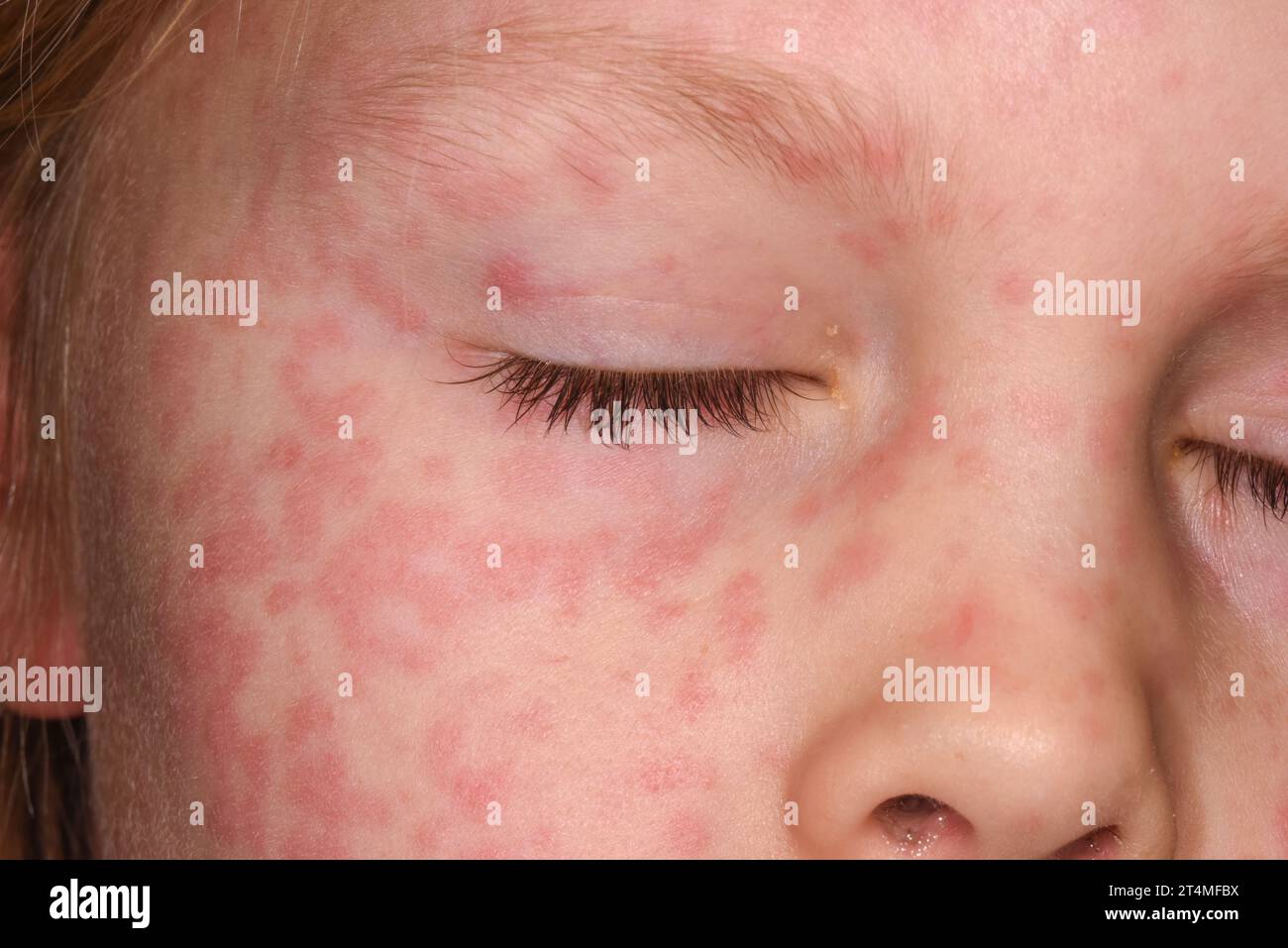 Erythema multiforme on a girl's face Stock Photo - Alamy