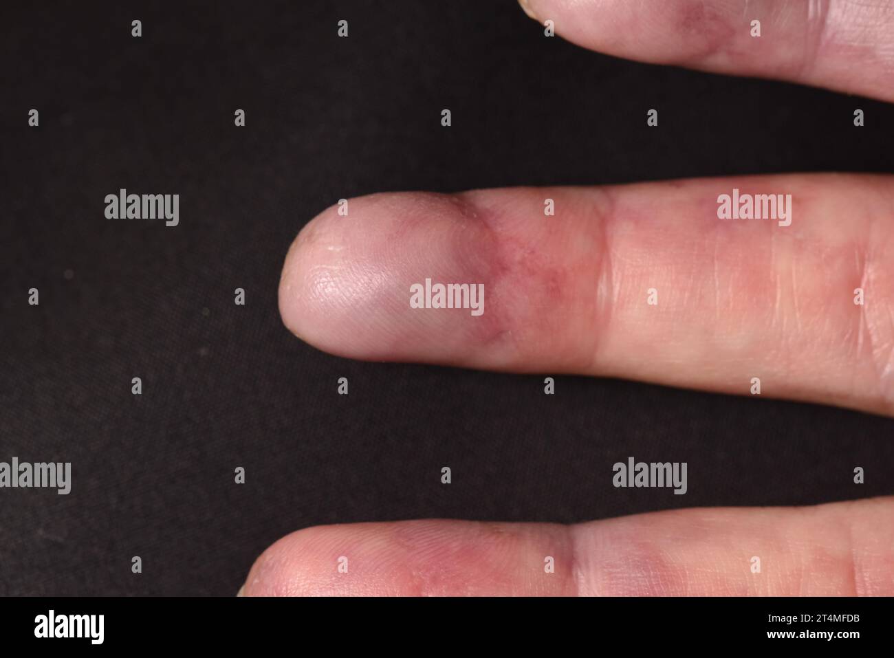 Ischemia on a woman's fingers Stock Photo - Alamy