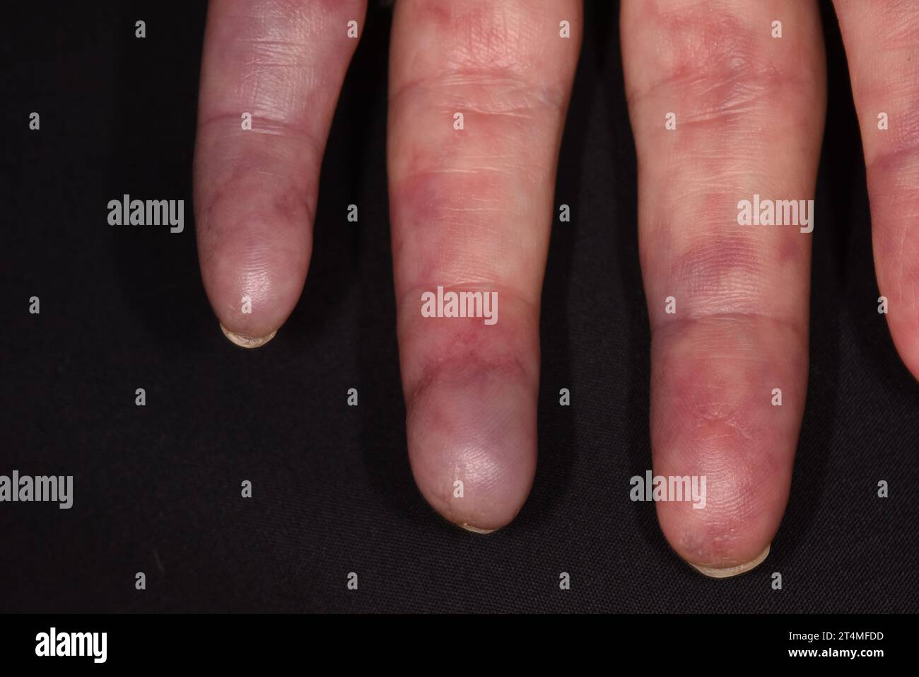 Ischemia on a woman's fingers Stock Photo - Alamy