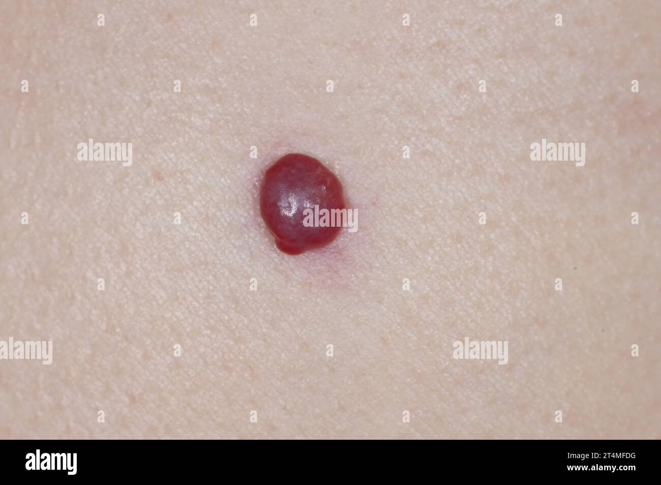 Pyogenic granuloma on girl's skin Stock Photo - Alamy