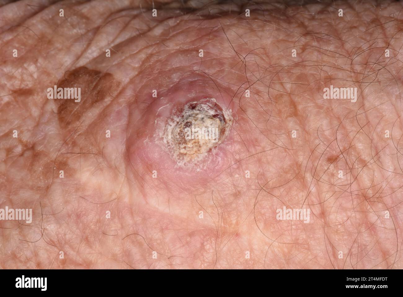 Solar keratosis on a man's hand Stock Photo - Alamy