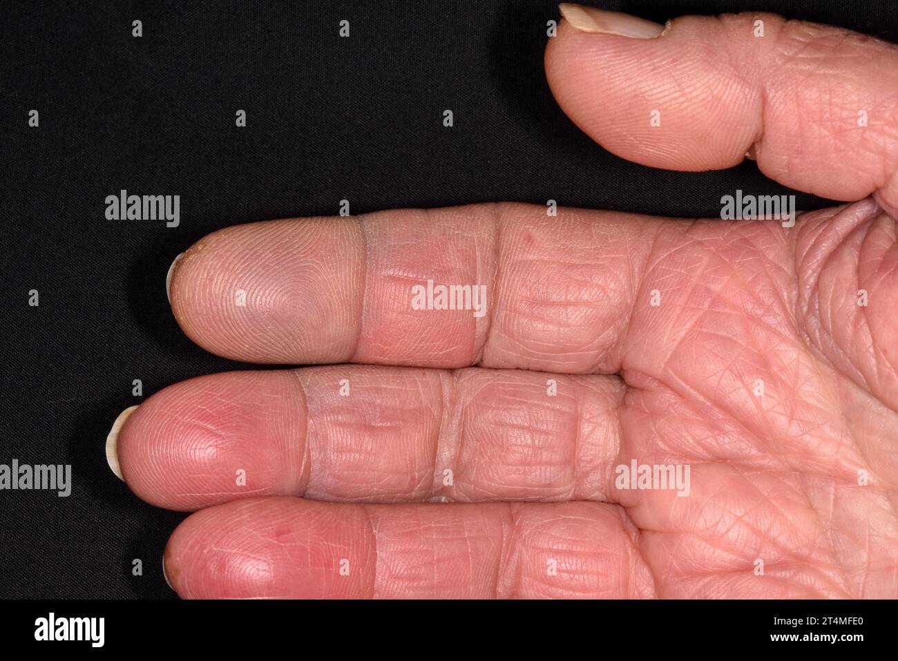 Raynaud's phenomenon in a woman's hand Stock Photo - Alamy