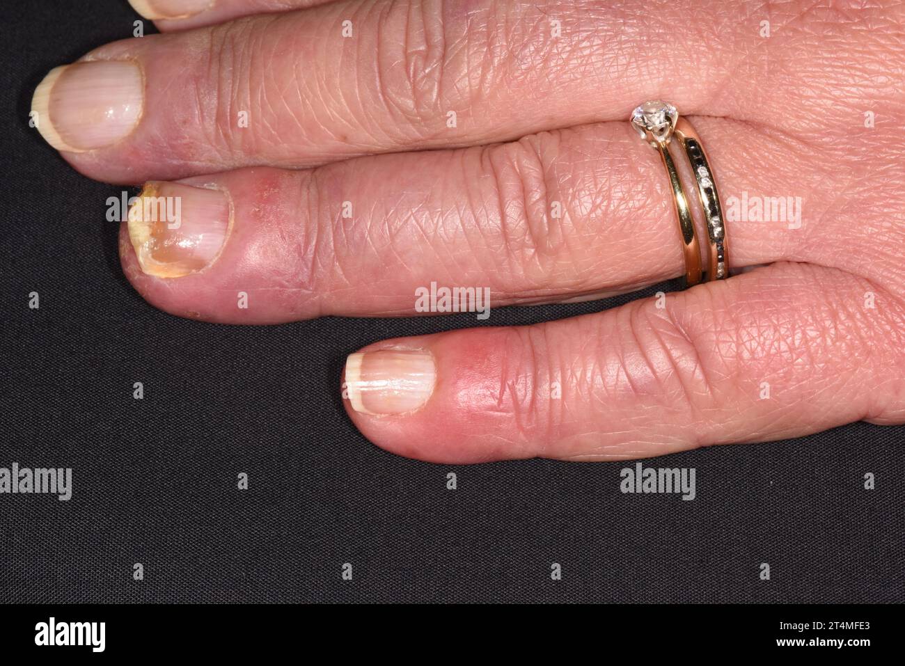 Raynaud's phenomenon in a woman's hand Stock Photo - Alamy