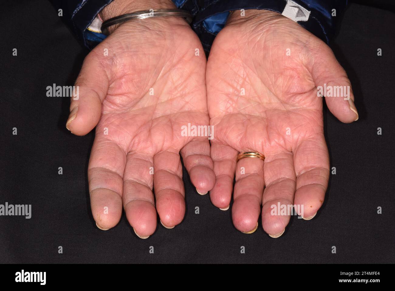 Raynaud's phenomenon in a woman's hands Stock Photo - Alamy
