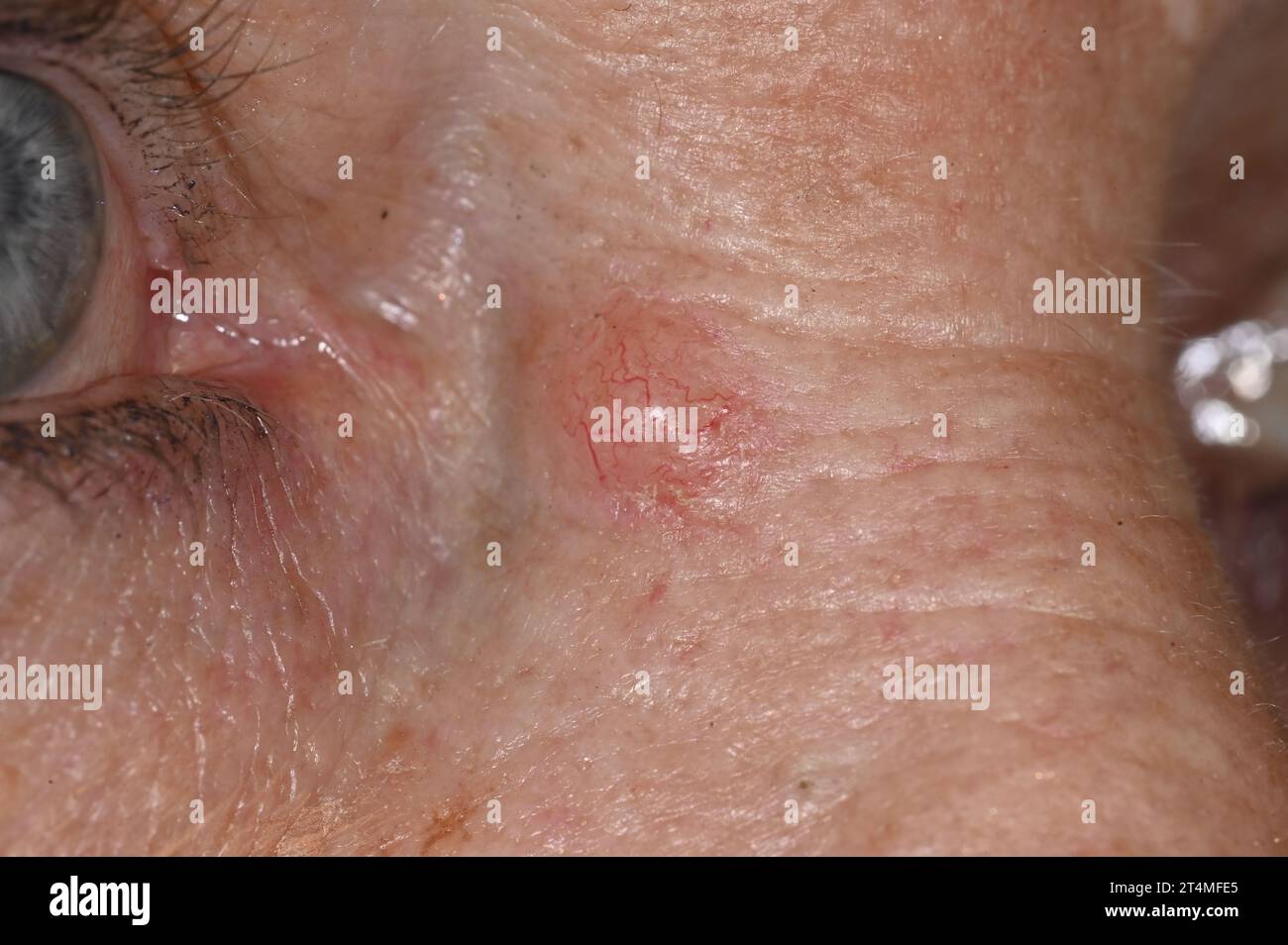Nodular basal cell carcinoma on a woman's face Stock Photo - Alamy