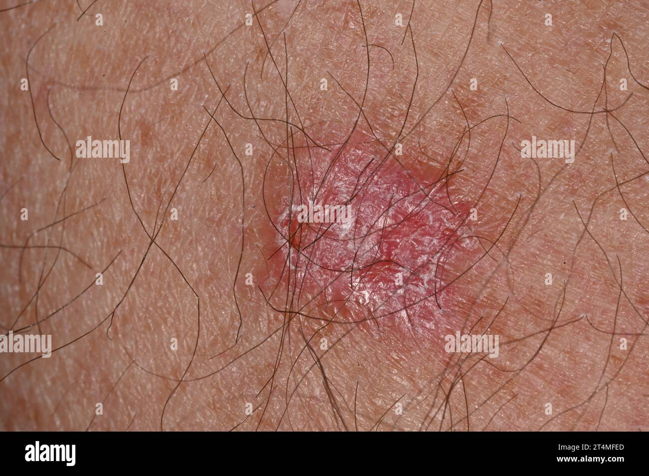 Basal cell carcinoma on a man's arm Stock Photo - Alamy