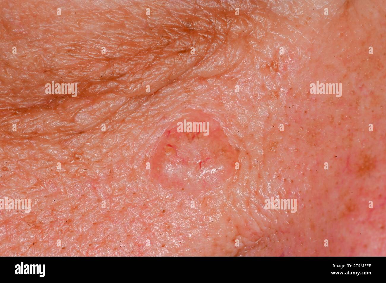 Nodular basal cell carcinoma on a man's cheek Stock Photo - Alamy