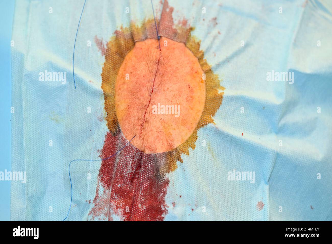Stitched wound after malignant melanoma excision Stock Photo - Alamy