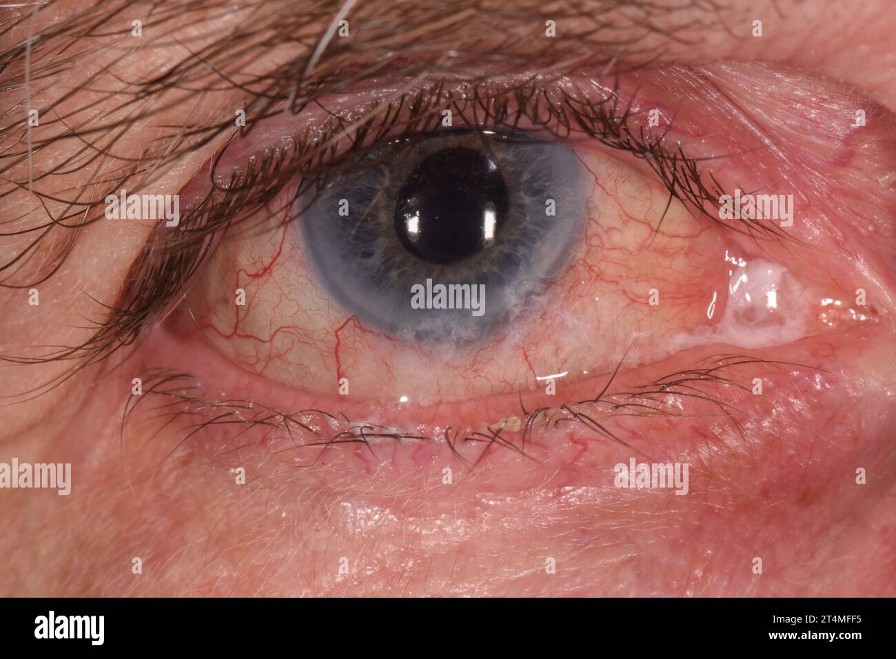 Conjunctival hyperaemia in a woman's eye Stock Photo - Alamy