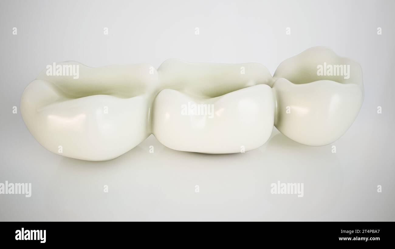 Dental Implant: Modern Solution for Tooth Replacement Stock Photo - Alamy Dental Implant: Modern Solution for Tooth Replacement Stock Photo - Alamy