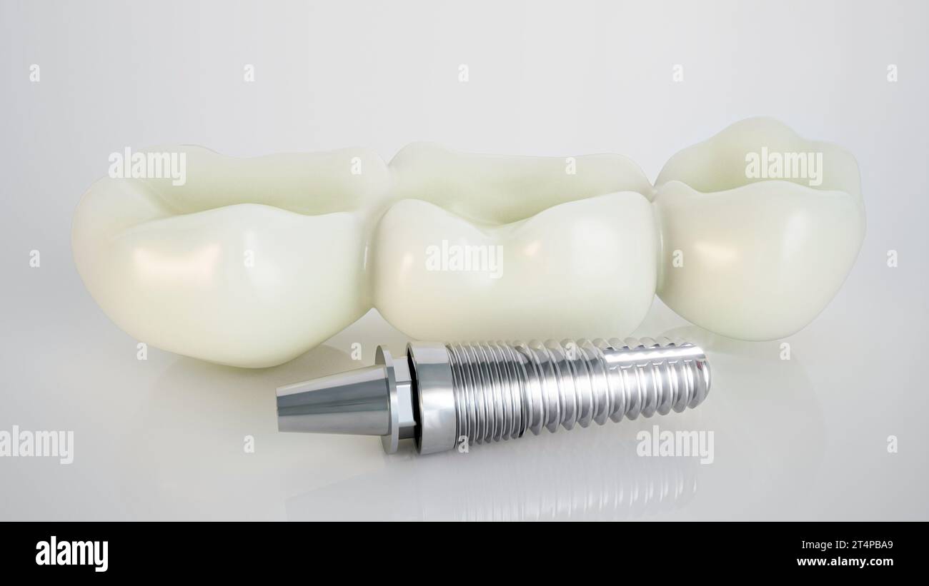 Dental Implant: Modern Solution for Tooth Replacement Stock Photo - Alamy Dental Implant: Modern Solution for Tooth Replacement Stock Photo - Alamy