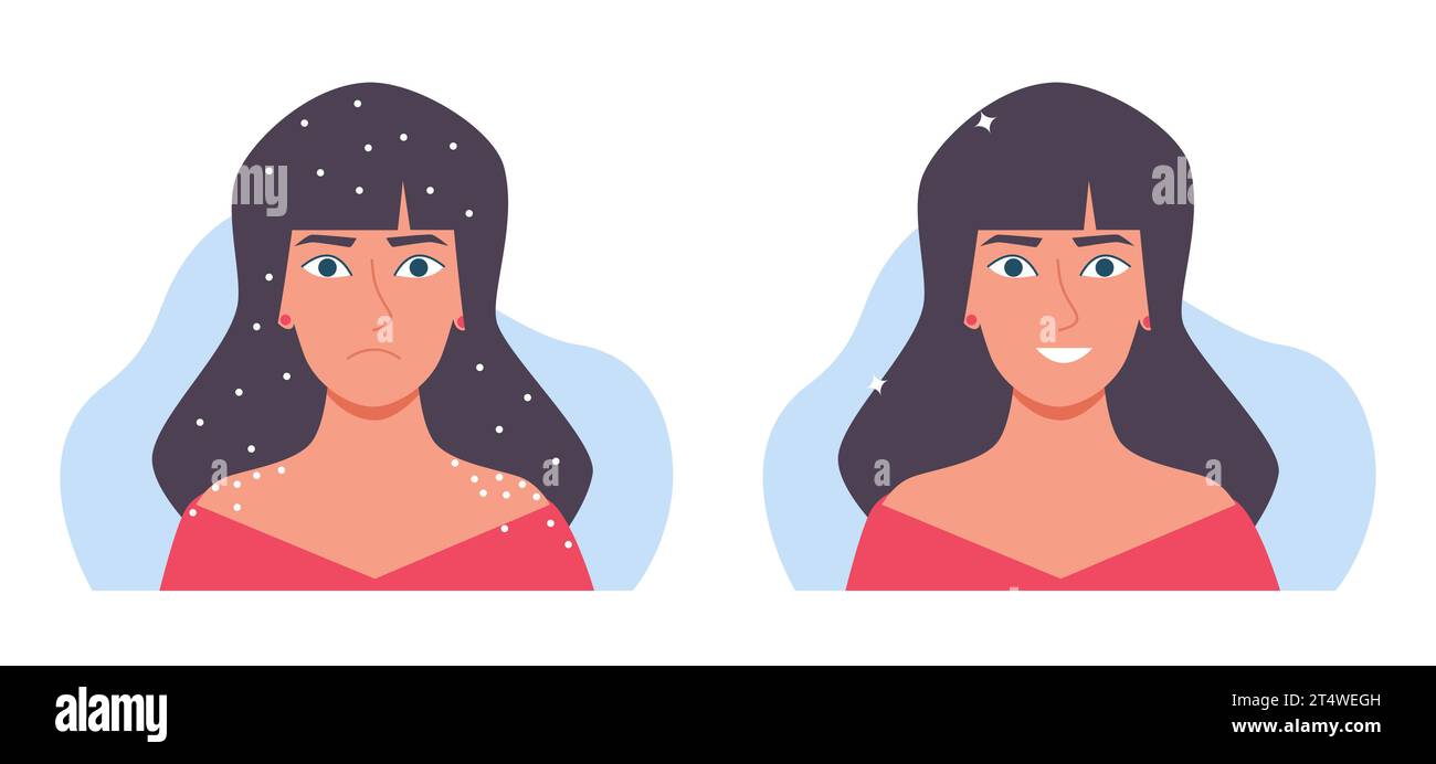 Sad woman with flake on head and shoulders and joyful woman without ...