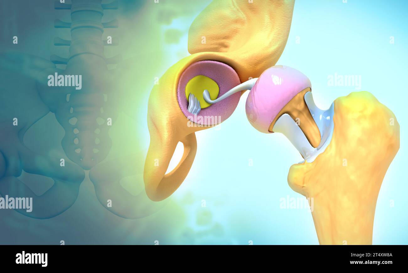 Hip replacement in the pelvis bone. 3d illustration Stock Photo - Alamy