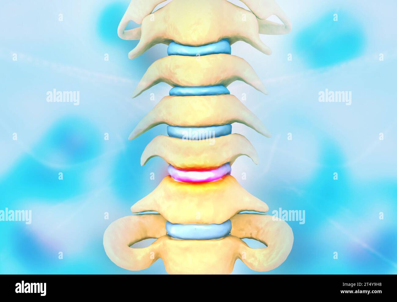 Disc problem of human spine. 3d illustration Stock Photo - Alamy