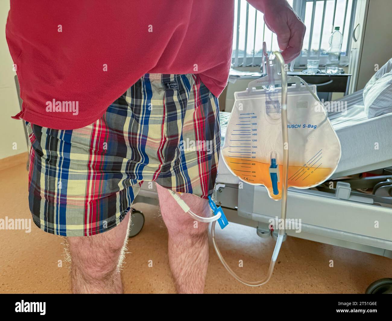 Man in hospital, after urological surgery, with urine bag on bladder ...