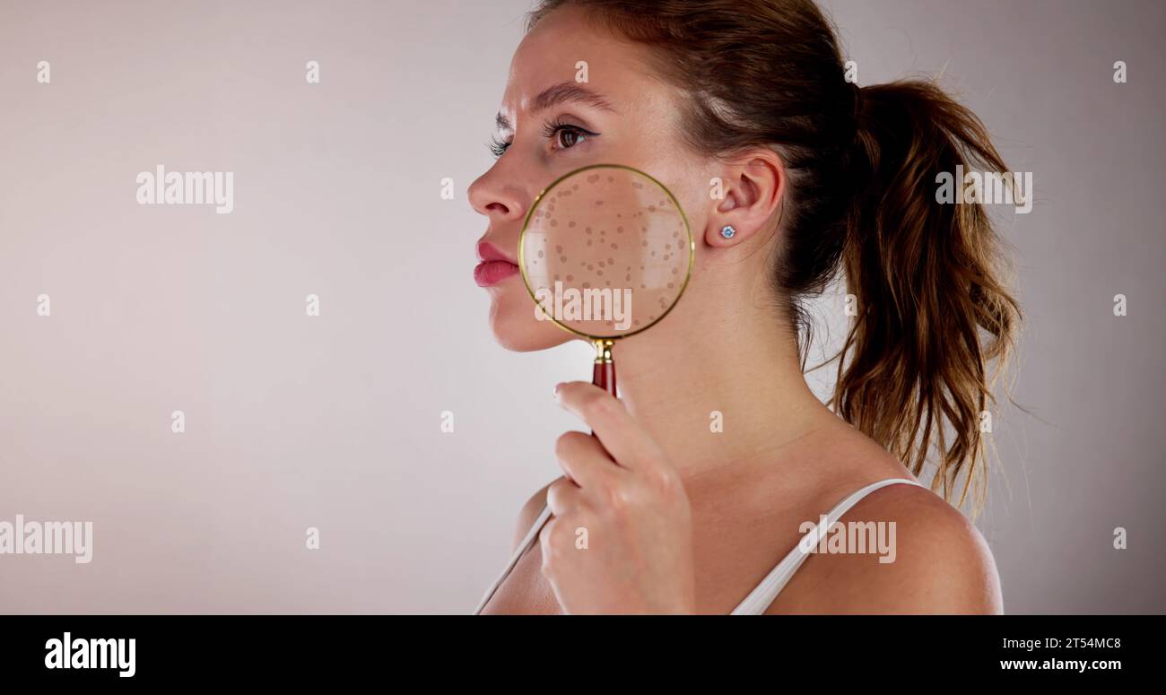 Rosacea Face Skin Problem And Aesthetic Treatment Stock Photo - Alamy