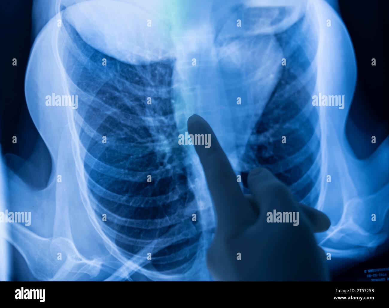 Lungs ribs x-ray scan test result Stock Photo - Alamy