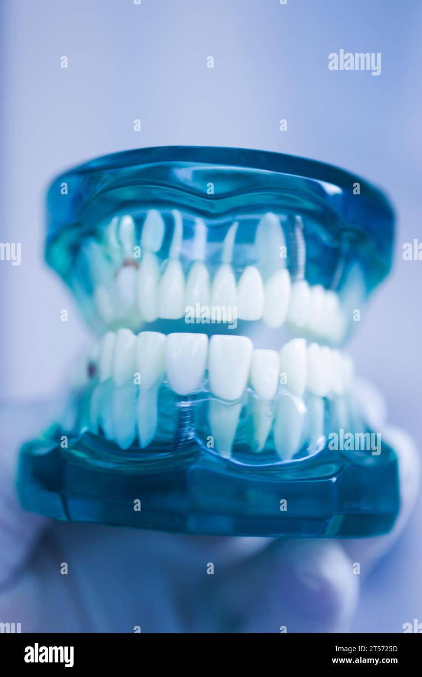 Dental tooth implant titanium prosthetic dentists model Stock Photo - Alamy