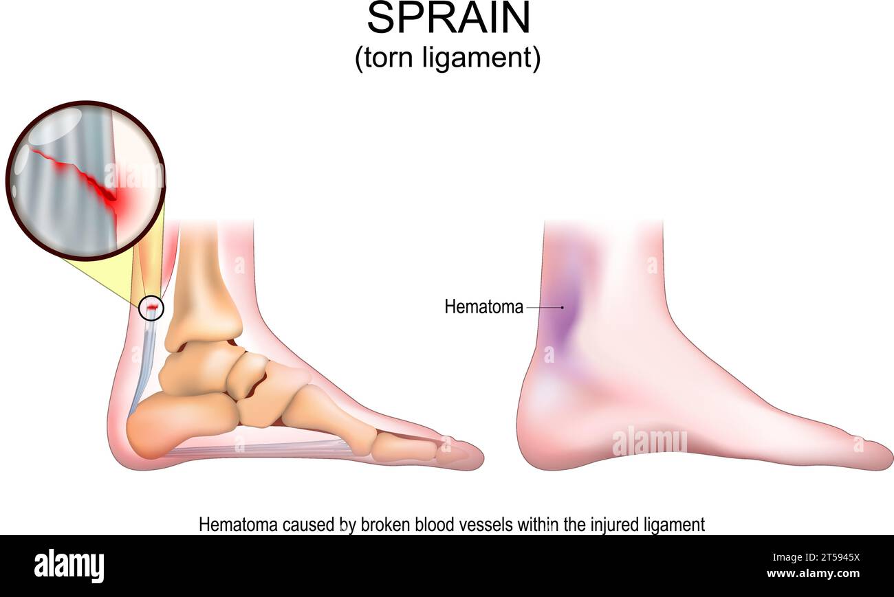 Sprain Torn Ligament After Painful Foot Twist Signs And Symptoms Of A Sprain Torn Ligament After Painful Foot Twist Signs And Symptoms Of A