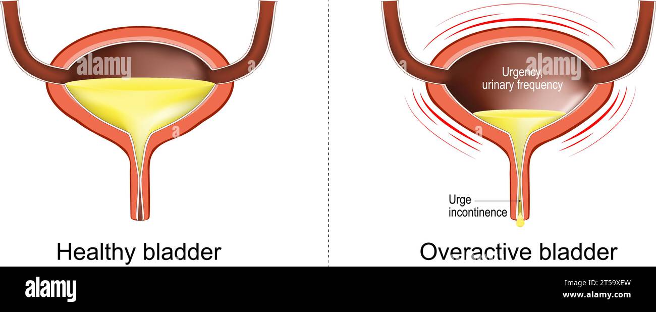 Overactive bladder. Loss of bladder control. urge incontinence. Signs and symptoms of a Bladder ...