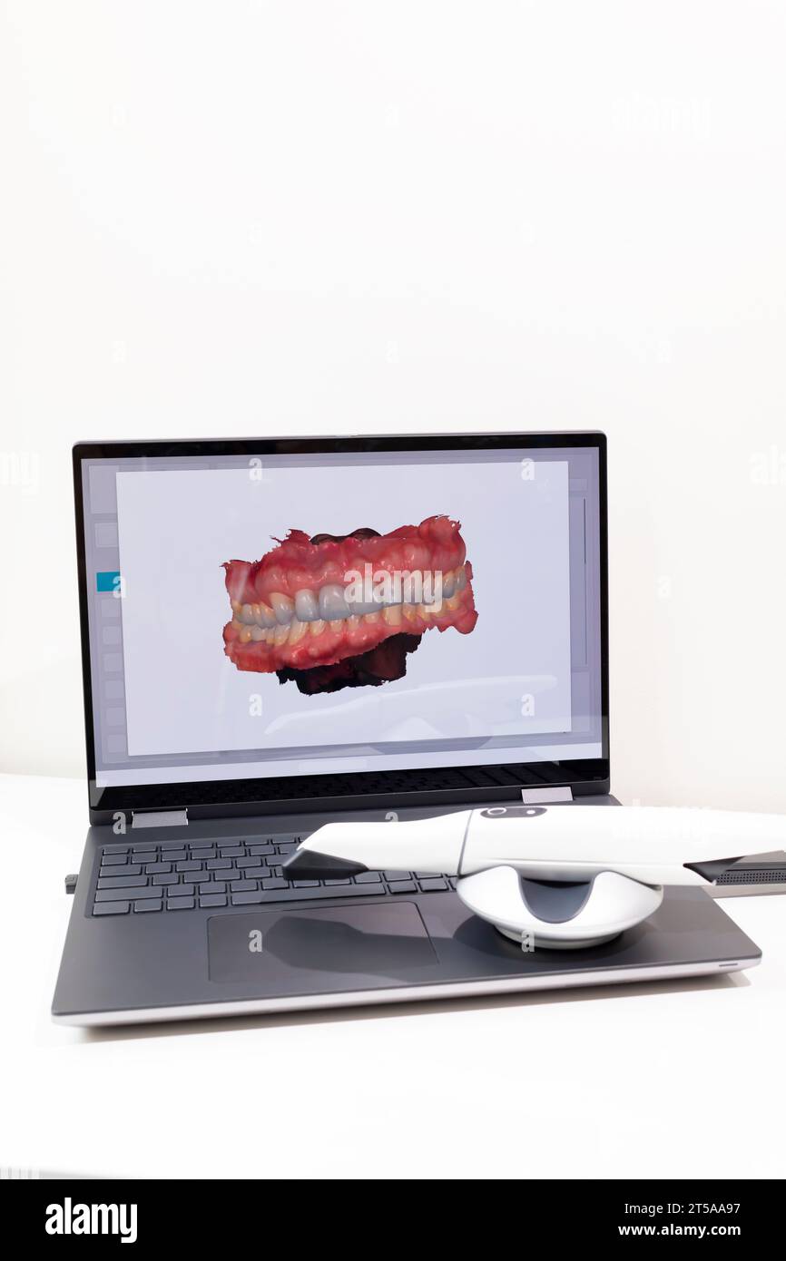 3D Picture of Scanned Teeth on Monitor of Computer, Notebook. White 3d ...