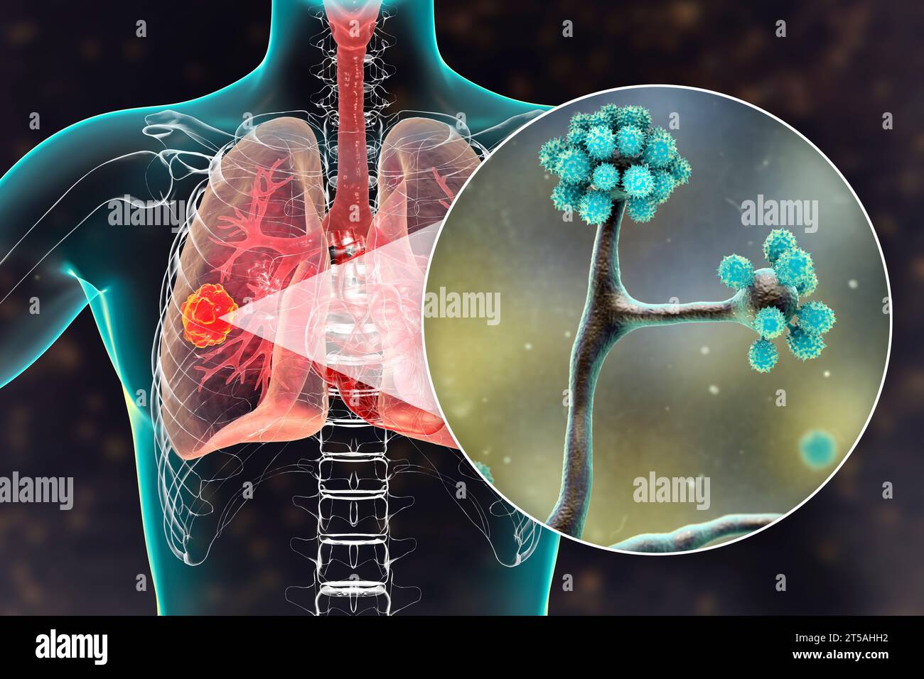Lung mucormycosis lesion, illustration Stock Photo - Alamy