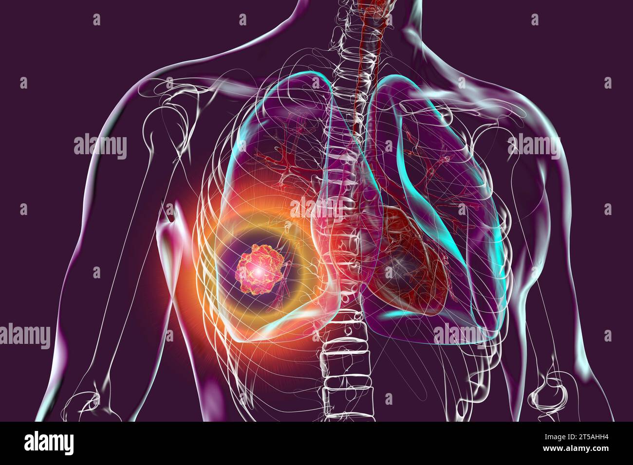 Lung cancer, illustration Stock Photo - Alamy