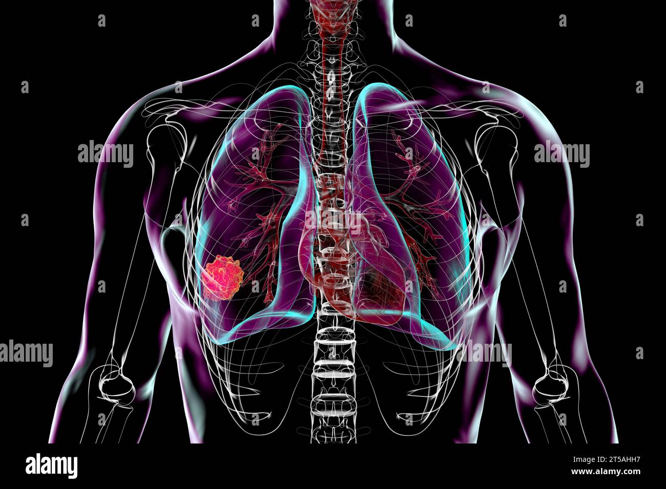 Lung cancer, illustration Stock Photo - Alamy