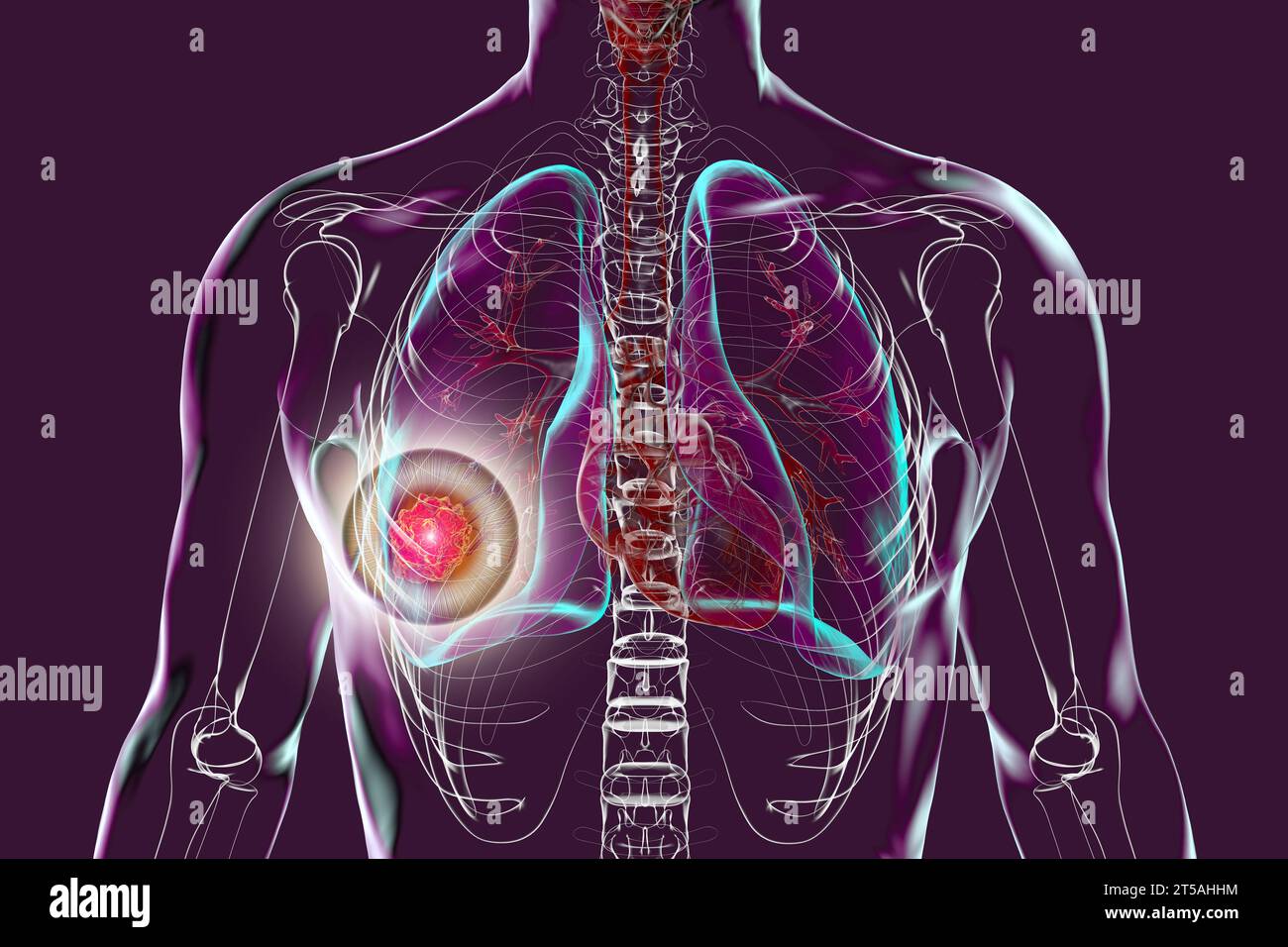 Lung cancer, illustration Stock Photo - Alamy