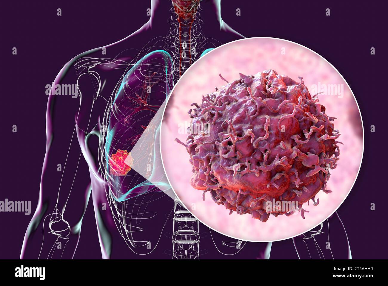 Lung cancer tumour and malignant cells, illustration Stock Photo - Alamy