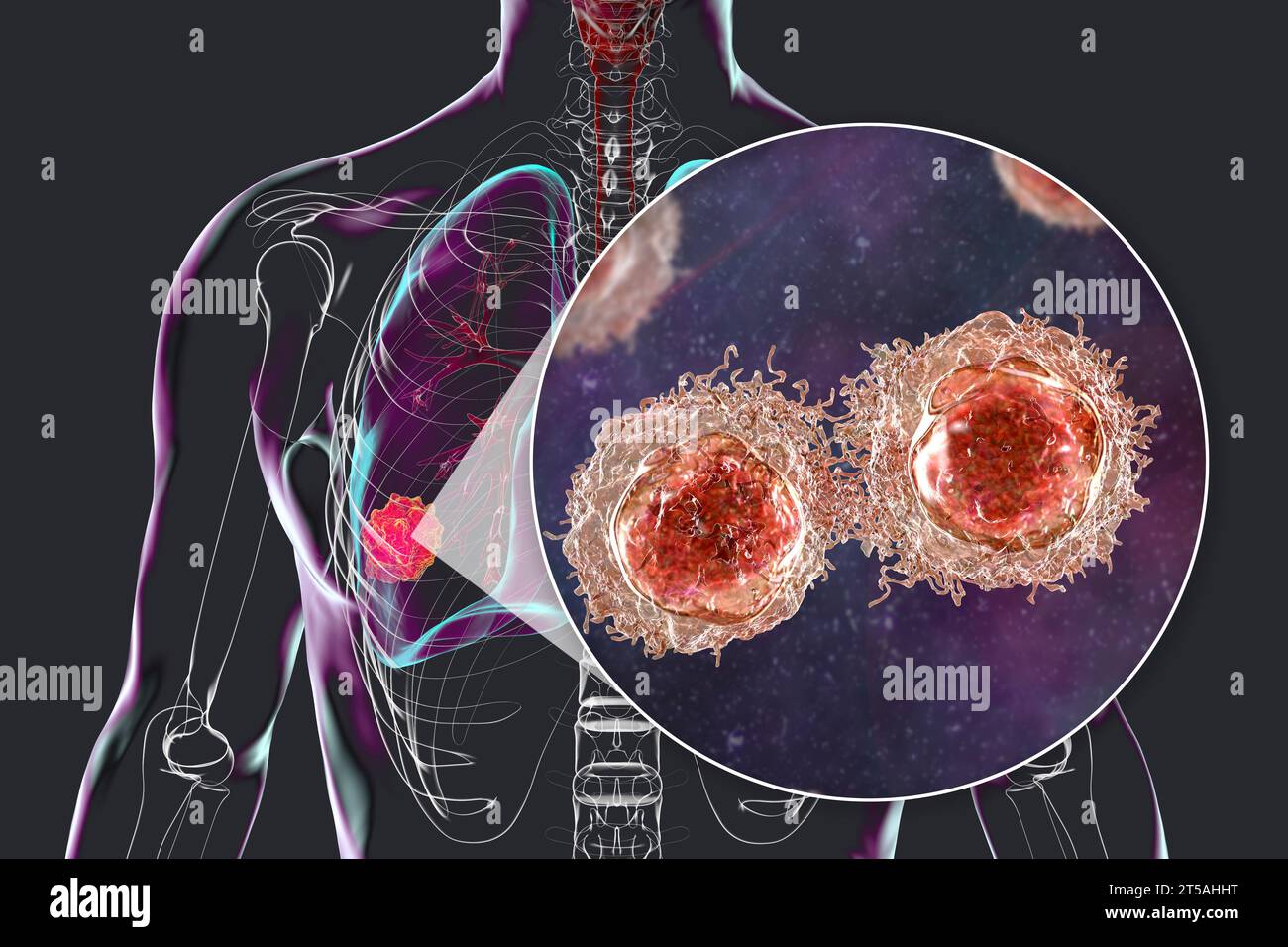 Lung cancer tumour and malignant cells, illustration Stock Photo - Alamy