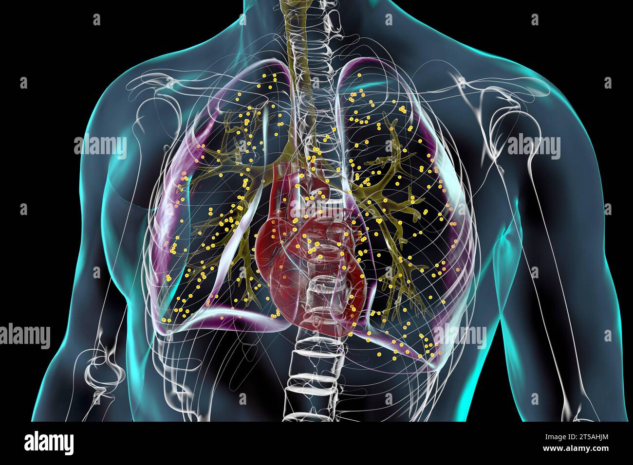 Lungs affected by miliary tuberculosis, illustration Stock Photo - Alamy