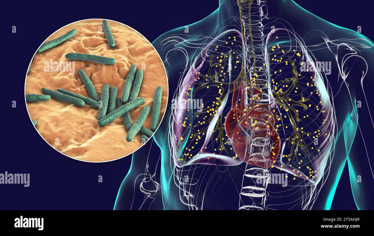 Lungs affected by miliary tuberculosis, illustration Stock Photo - Alamy