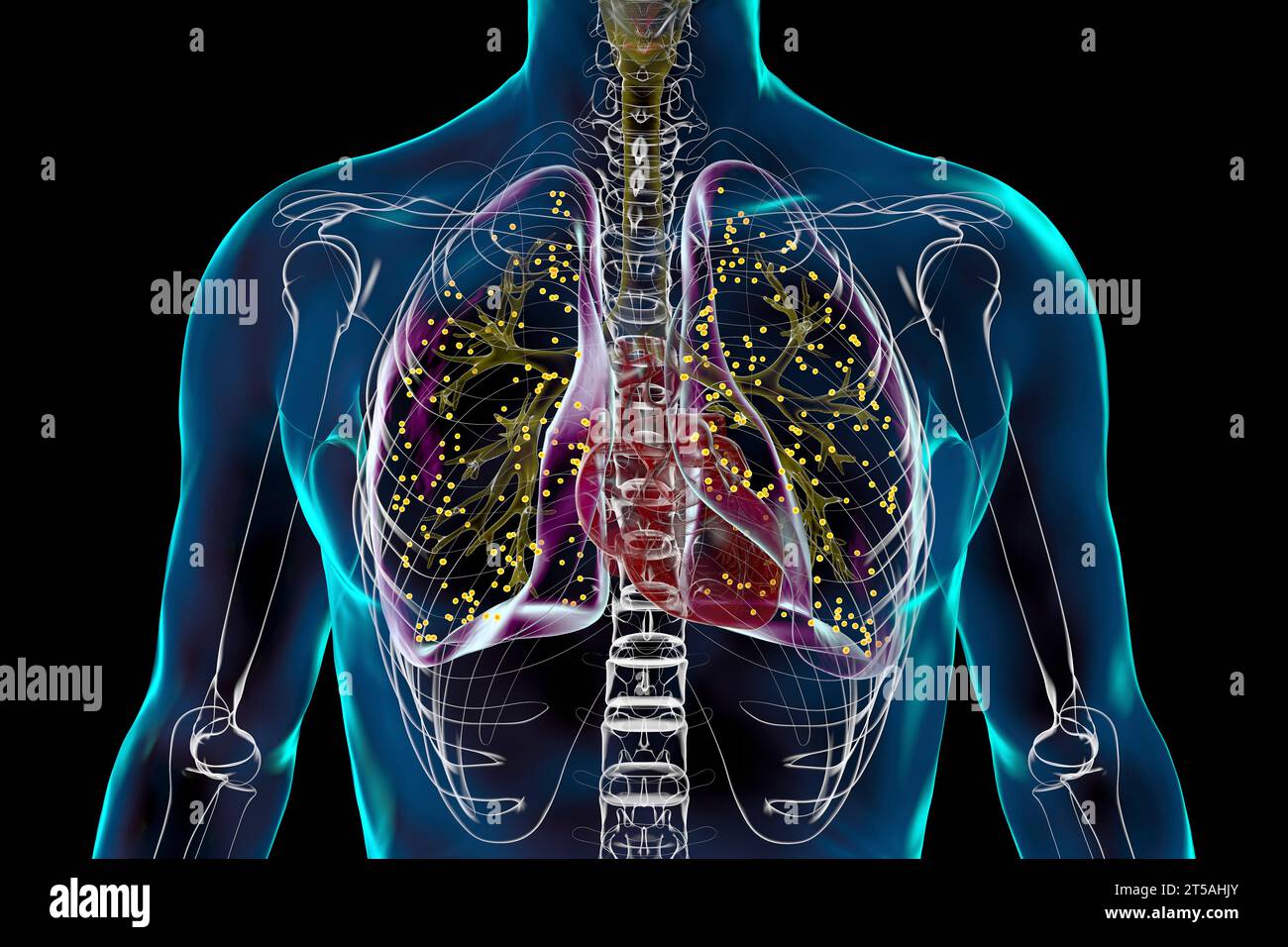 Lungs affected by miliary tuberculosis, illustration Stock Photo - Alamy