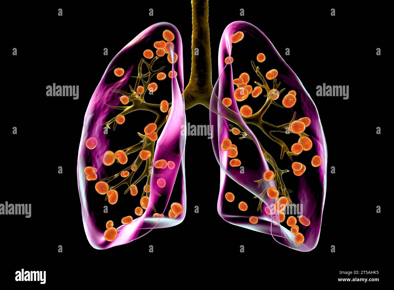 Histoplasmosis Causes Symptoms Treatment Histoplasmosis