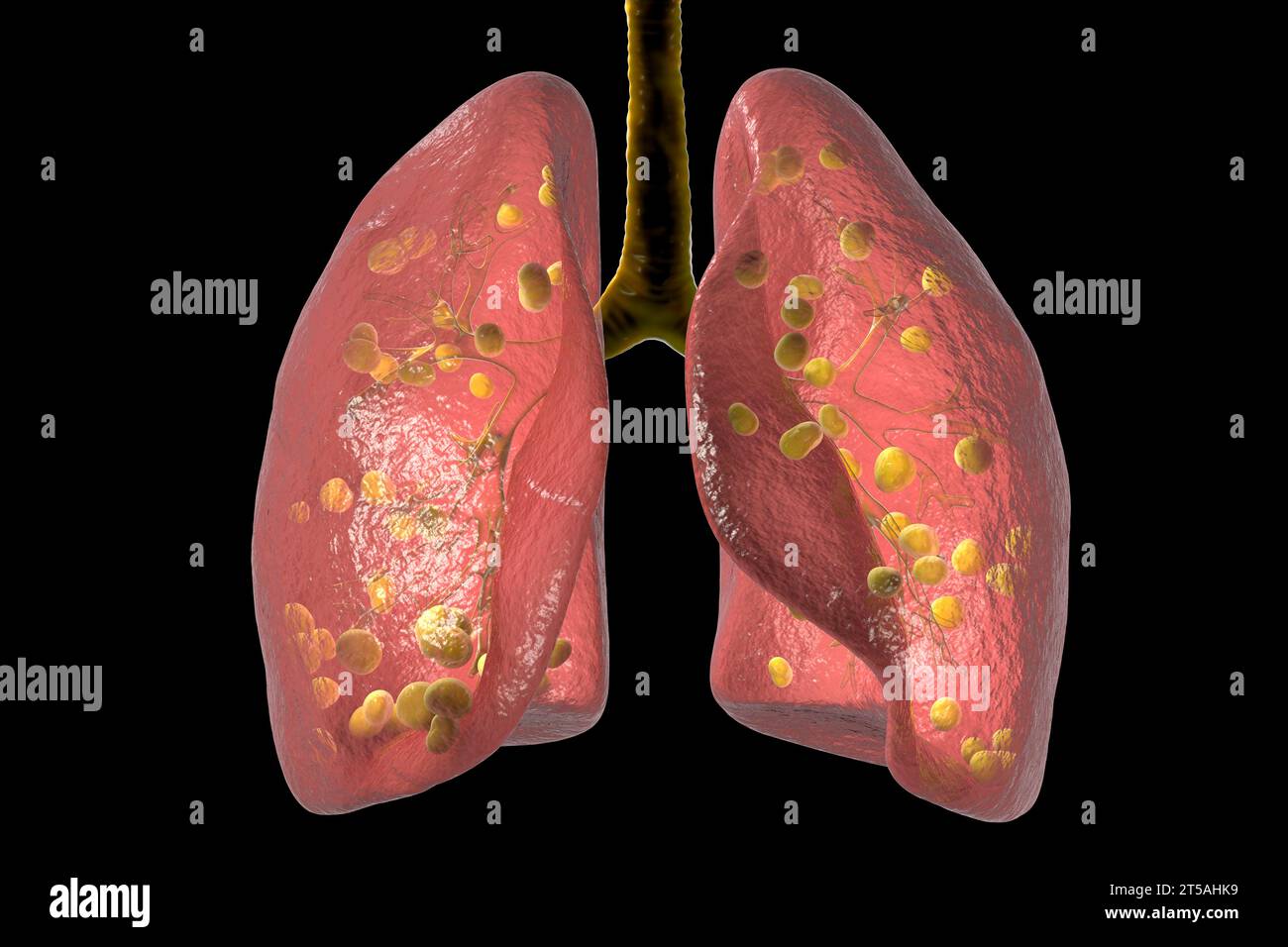 Lung histoplasmosis, illustration Stock Photo - Alamy