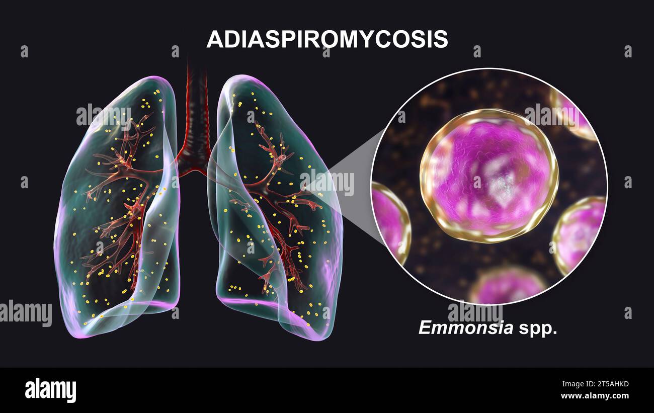 Lung adiaspiromycosis, illustration Stock Photo - Alamy