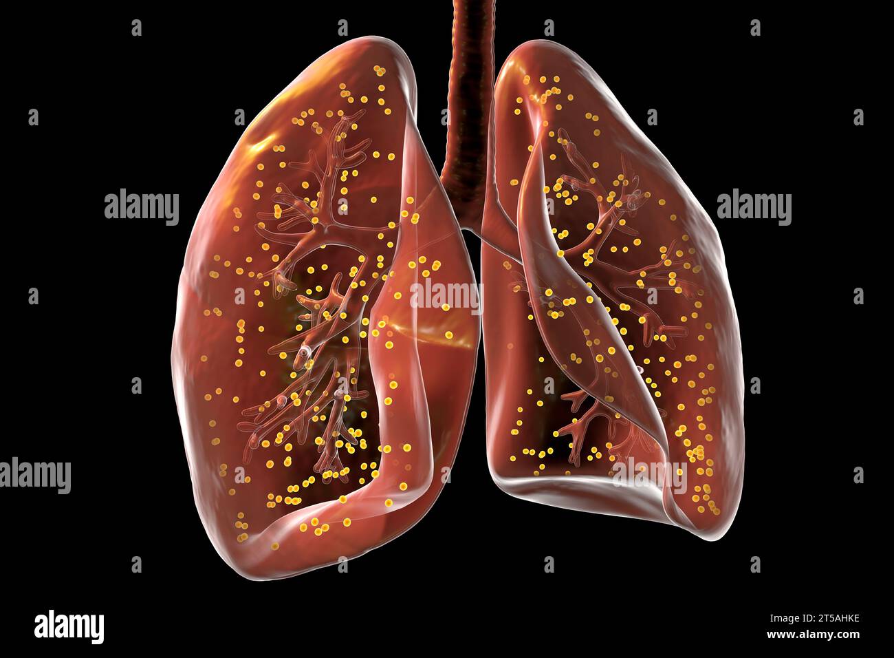 Lungs affected by miliary tuberculosis, illustration Stock Photo - Alamy