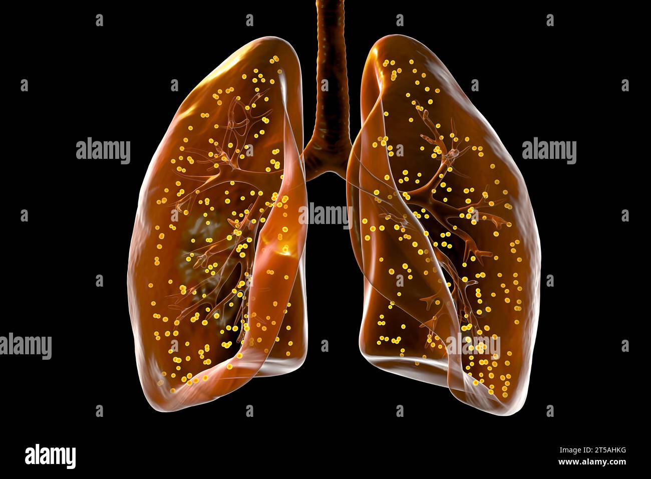 Miliary lung tuberculosis hi-res stock photography and images - Alamy